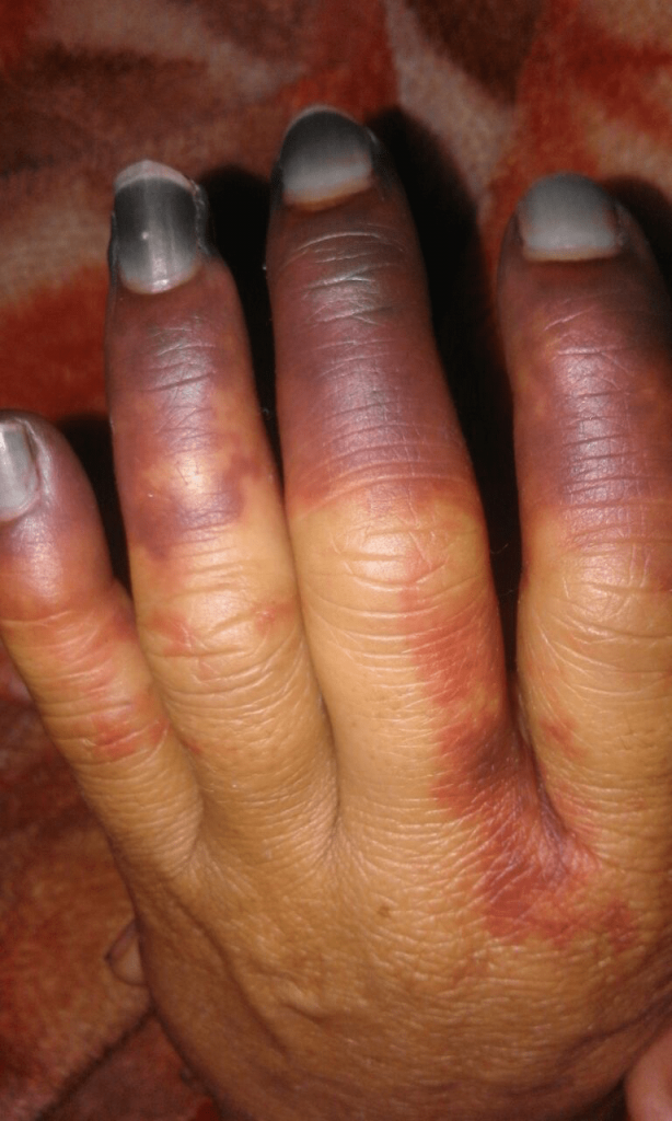 Peripheral Artery Disease (PAD) - Best Vascular Surgeons in Delhi ...