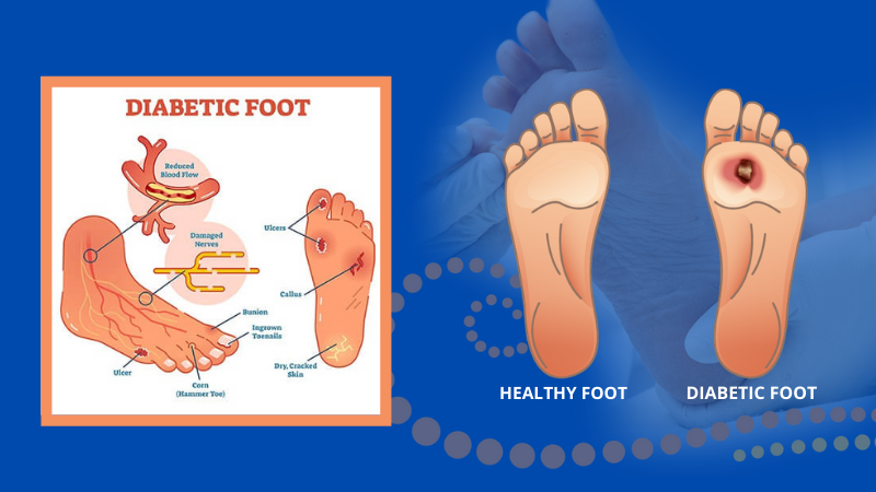 Diabetic Foot Problem - Signs, Symptoms and Care